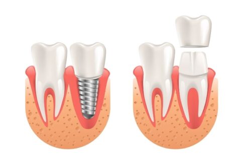 Fogkorona: a megoldás egyetlen fog pótlására - Dentpoint