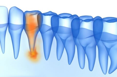 A fogbél gyulladás okai, a gyulladt fog kezelése - Dentpoint